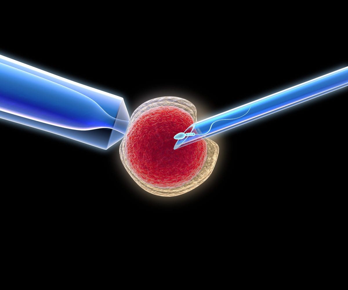 ICSI Explained: Success Rates, Risks and What to Expect - IVI UK